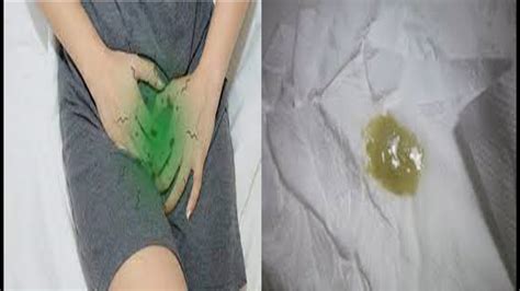 Corrimento Esverdeado Sem Cheiro E Sem Coceira O Que Pode Ser YouTube