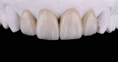 5 Ways To Fix Overlapped Front Teeth Easily Best Guide Year