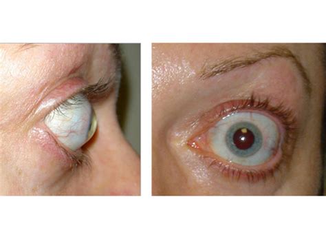 Upper Eyelid Retraction The Dh Verity Eye Practice
