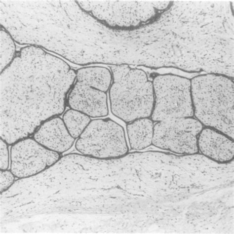 Low Power View Of The Primary Phyllodes Tumour Showing The Relatively