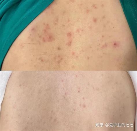 男生整个后背长满痘痘，摸着麻麻赖赖的还很痒，到底怎样才能去干净？皮肤科医生教你一套专业去后背痘方法，一个月后背干干净净！ 知乎