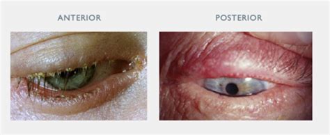 Ophthalmology Flashcards Quizlet