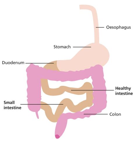 Antenatal Information For Bowel Atresia Resource Library Sheffield