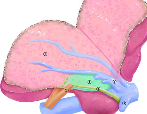 Diagram Of The Surgical Procedure Step 1 Creation Of A Wide Space Download Scientific Diagram