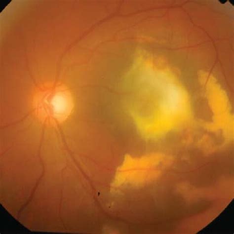 Color Fundus Photograph Of The Left Eye Showing Vitreous Hemorrhage