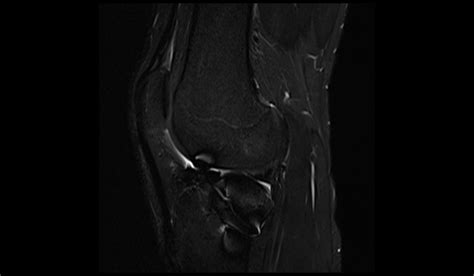 Mars Mri Metal Artifact Reduction Mri