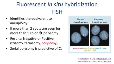 Can We Find Early Cholangiocarcinoma In Psc Youtube