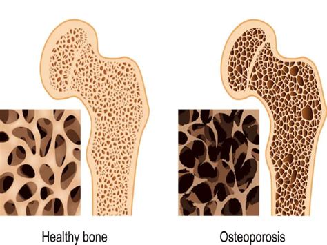 Bone Loss From Osteoporosis Air Pollution Can Damage Your Bone Health