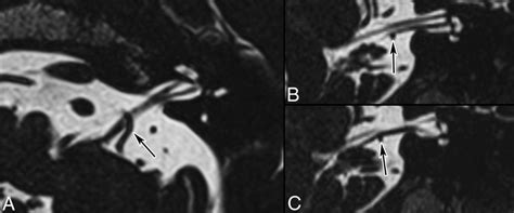 Right Hfs Caused By An Aica Loop In A 60 Year Old Man Fusion Of 3d T2 Download Scientific