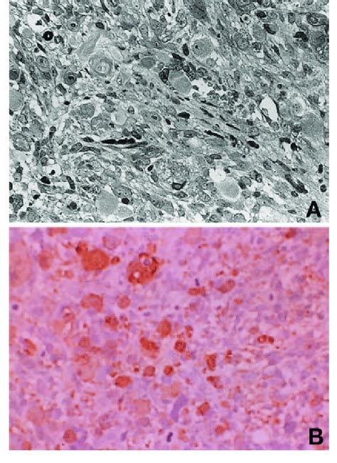 A Photomicrograph Of The Tumor Showing Complicated Fascicles Of