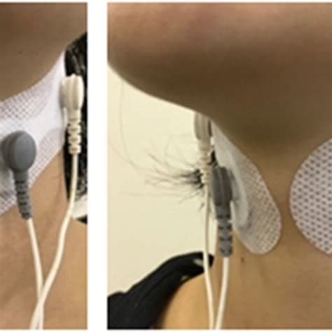 Positions Of The Electrodes An Interferential Current Of 50 Beatss