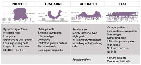 Types Of Stomach Cancer