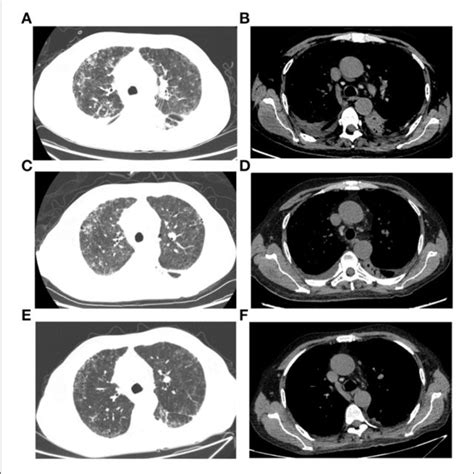 Bronchoscopy And Ultrasound Imaging Of An Abscess Ab Right Middle