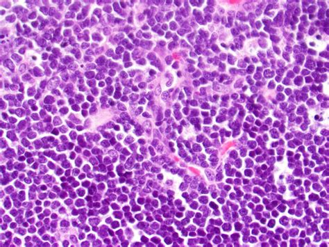 Lymphocytic Leukemia Histology
