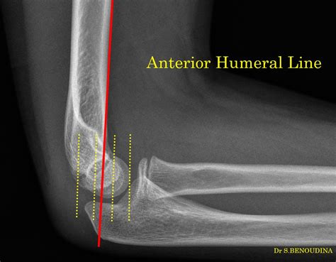 Anterior Humeral Line Radiology Case Radiology