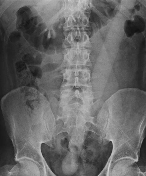 Rectal Foreign Body