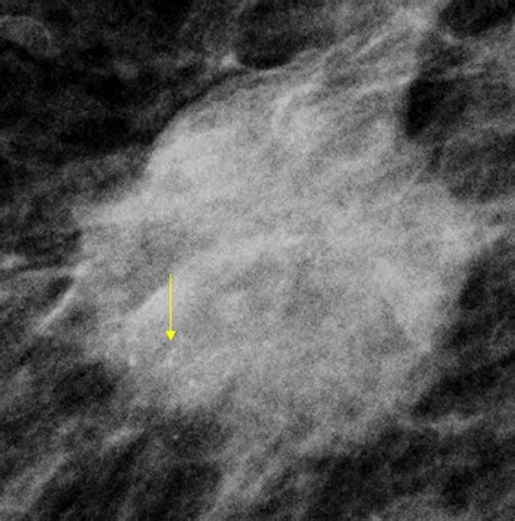 Breast And Axilla 5 2 Malignant Breast Lesions Case 5 2 2 Breast