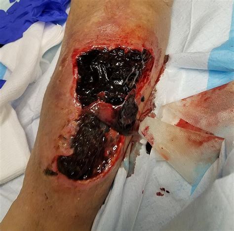 Treatment Of Soft Tissue Necrosis On The Leg Caused By Compartment