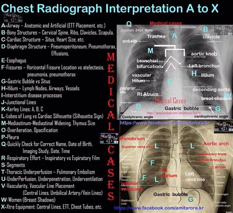 Chest Rx Interpretation Medizin Pneumologie Pathologie