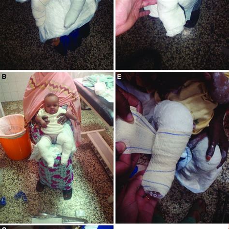 Ignacio Ponseti Ignacio Ponseti Download Scientific Diagram