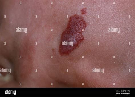 A Vascular Naevus Also Known As A Strawberry Mark On The Forehead Of