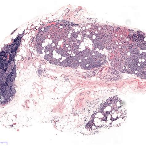 Patient B See Text Parathyroid Tissue From An Incisional Biopsy Of A Download Scientific