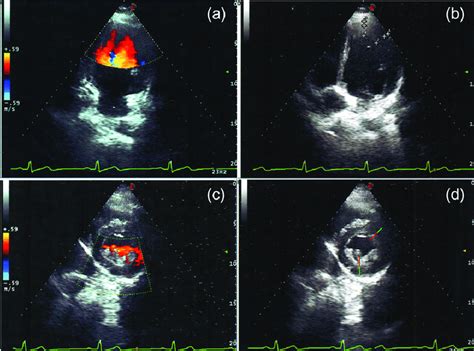 Echocardiogram A Apical 4 Chamber View In Color Doppler Imaging Download Scientific Diagram