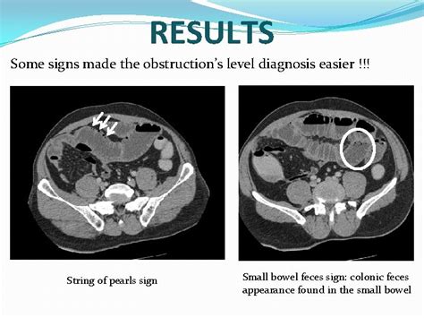 New Approach To Acute Bowel Obstruction By Multidetector