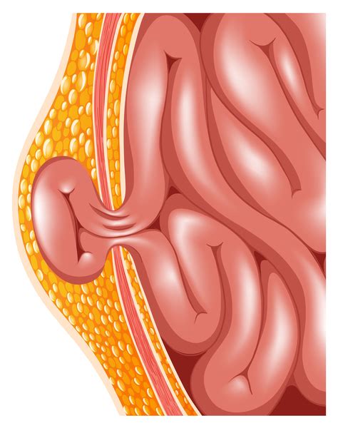 Mucopolysaccharidosis Type Iv Medlineplus Genetics