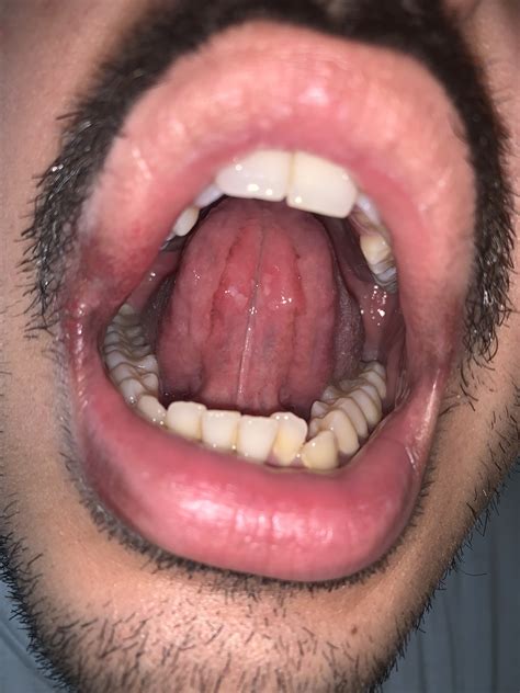 White Patches Under Tongue Askdocs