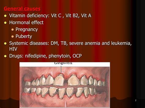 Ppt Gingivitis Inflammation Of Gingival Tissues Commonly Associated With Dental Plaque