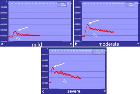 Quantitative Contrast Enhanced Ultrasound Ceus Ac Time Intensity
