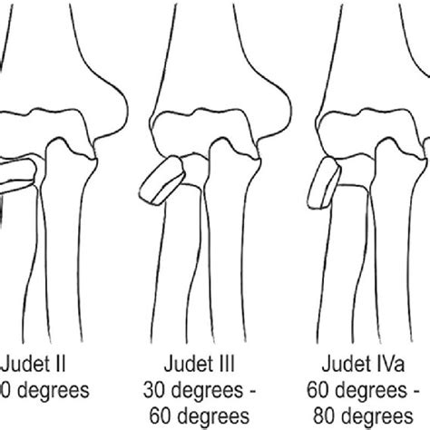 Diagrammatic Description Of Judet Classification Of Radial Neck