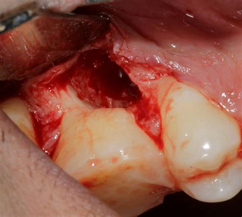 Avoiding Dental Implants And The Sinus Lift Procedure Revisiting Maxillary Molar Root
