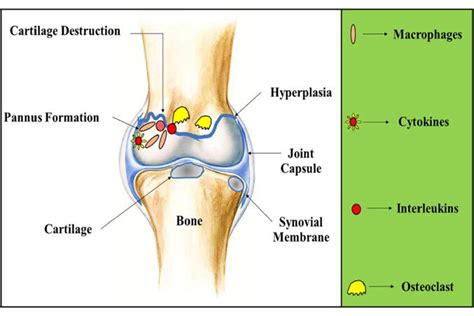 Rheumatoid Arthritis Diagram