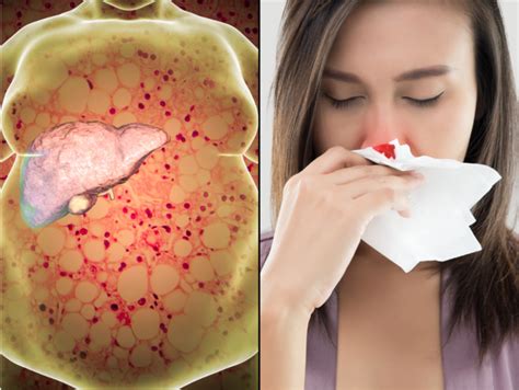 Fatty Liver Disease Symptoms Frequent Nosebleed Is A Warning Sign Of