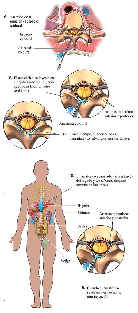 Anestesia Epidural Y Anestesia Raquídea Eekjrm