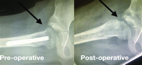 Pre Operative And Post Operative X Ray Lauenstein View After Plate