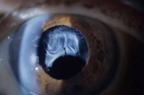 Optometry Dx When A Posterior Chamber Iol Shifts Optometry Advisor