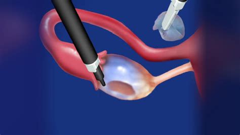 Laparoscopic Ovarian Cystectomy Saudi German Health