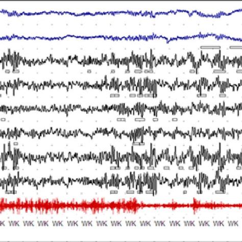 A 30 Seconds Epoch Consisting Of The Parameters Of Staging Sleep Eeg