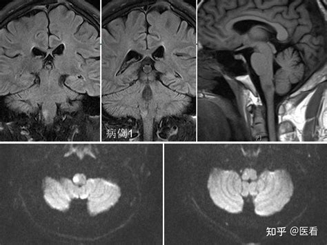 延髓背外侧综合征 知乎