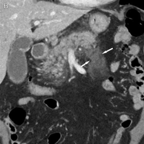 Interstitial Edematous Pancreatitis In A 78 Year Old Male A Axial