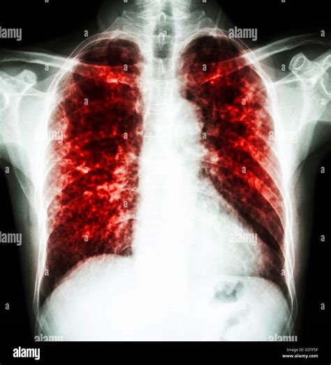 Pulmonary Tuberculosis TB Chest X Ray Show Alveolar 48 OFF