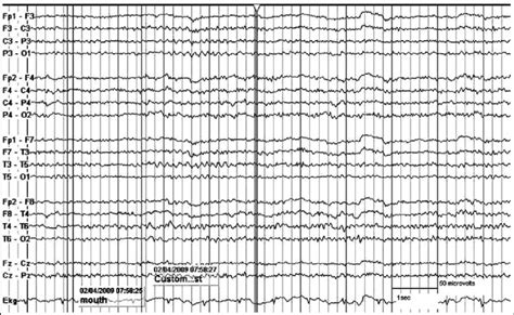 Eeg Showing Onset Of The Patients Typical Focal Seizure From The Right