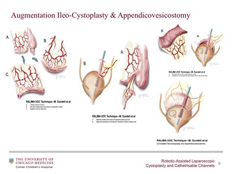 Appendicovesicostomy
