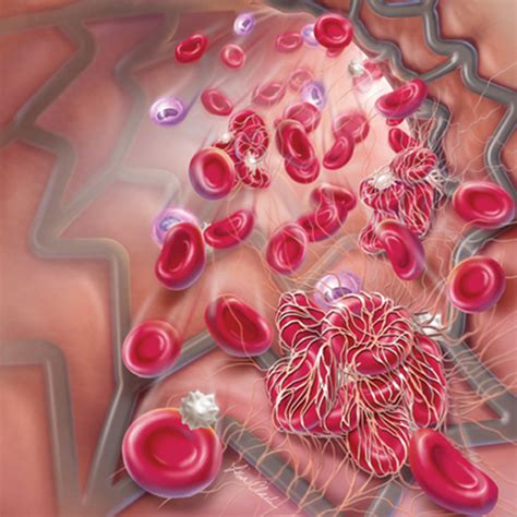 What Should Be The Duration Of Dual Antiplatelet Therapy