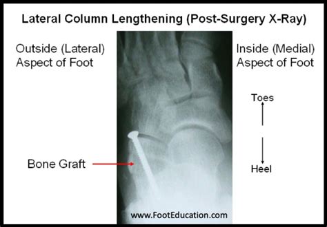 Lateral Column Lengthening Footeducation
