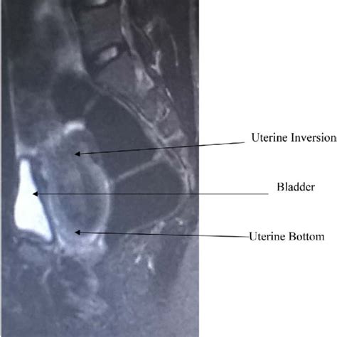 Transection Of The Uterus Exposing The Serosal Surface Of The Uterine