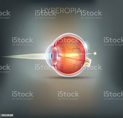 Hyperopia Vision Disorder Stock Illustration Download Image Now